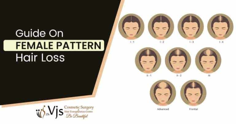 Guide on female pattern hair loss